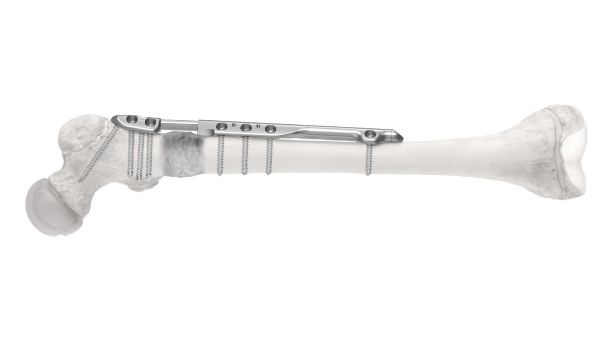 Precice Nail (Limb Lengthening) | Centre for Advanced Orthopaedics