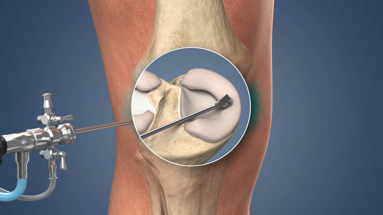 Meniscus Repair – Centre for Advanced Orthopaedics